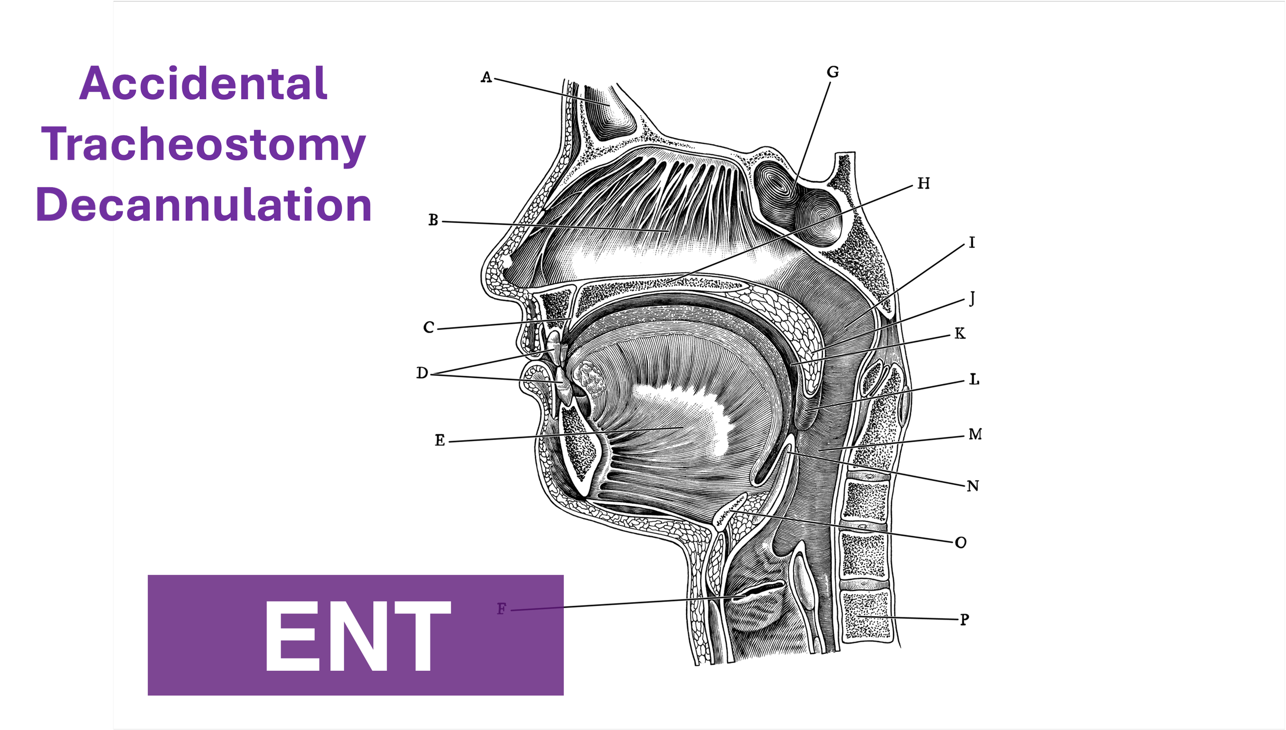 Accidental Tracheostomy Decannulation — NUEM Blog