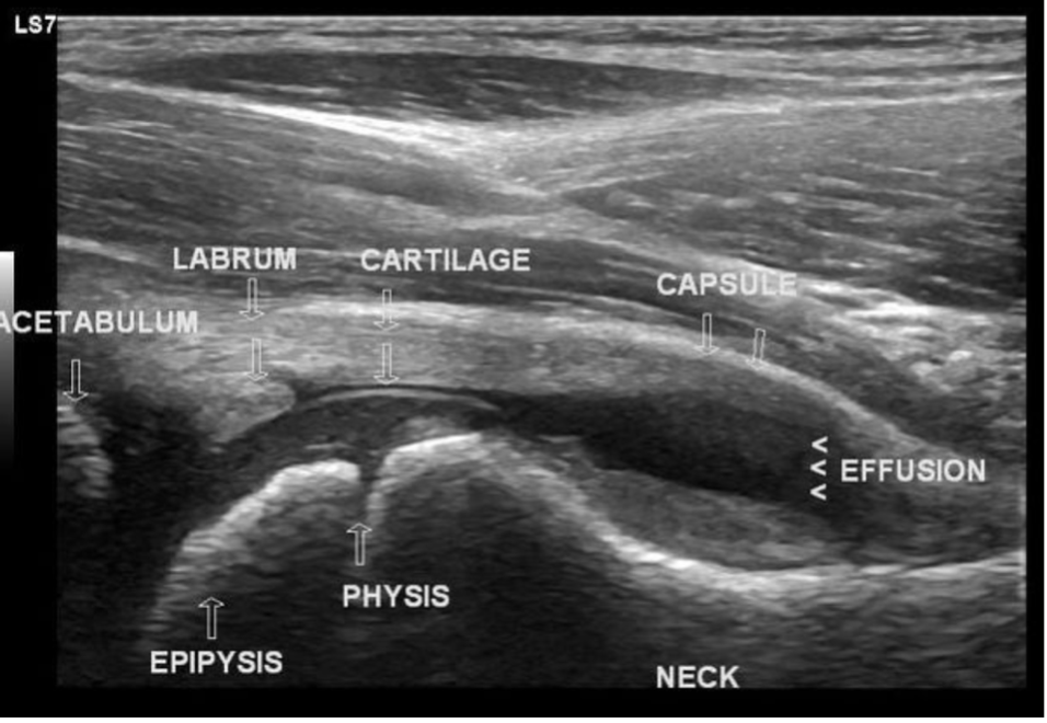 Hip Pain in Pediatrics — NUEM Blog