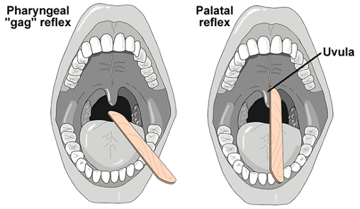 Vagal Maneuvers Simplified — NUEM Blog