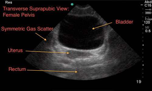 EMERGENCY ULTRASOUND — MMHEME