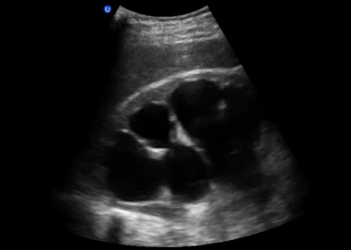 Renal Ultrasound — MMHEME