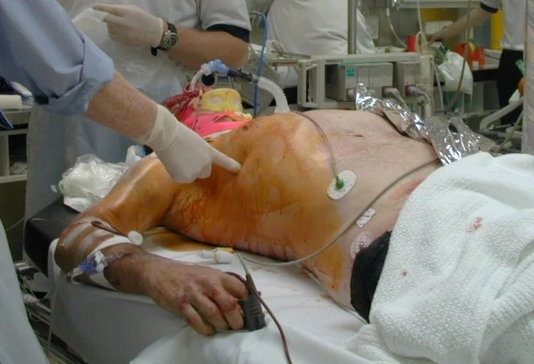 CHEST DRAINS — MMHEME