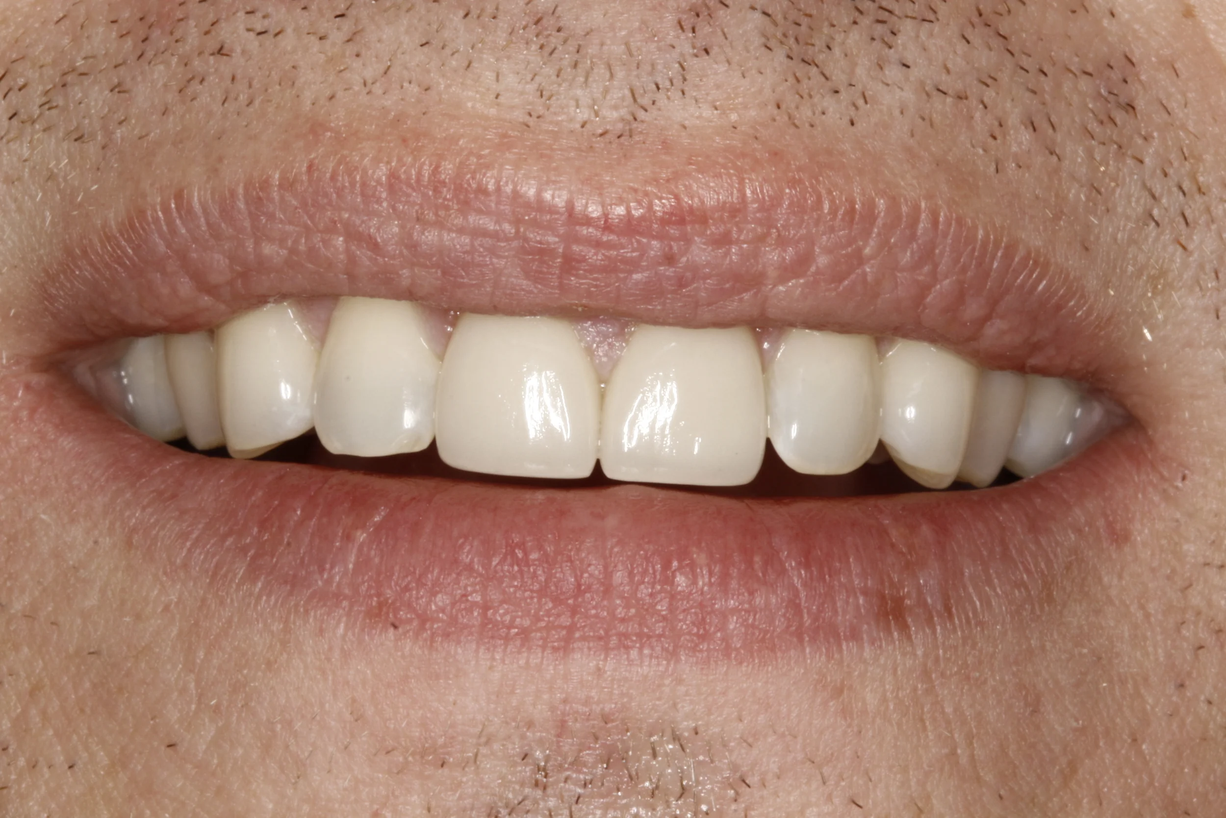 Veneers Case — Lisa L. Buttaro DDS