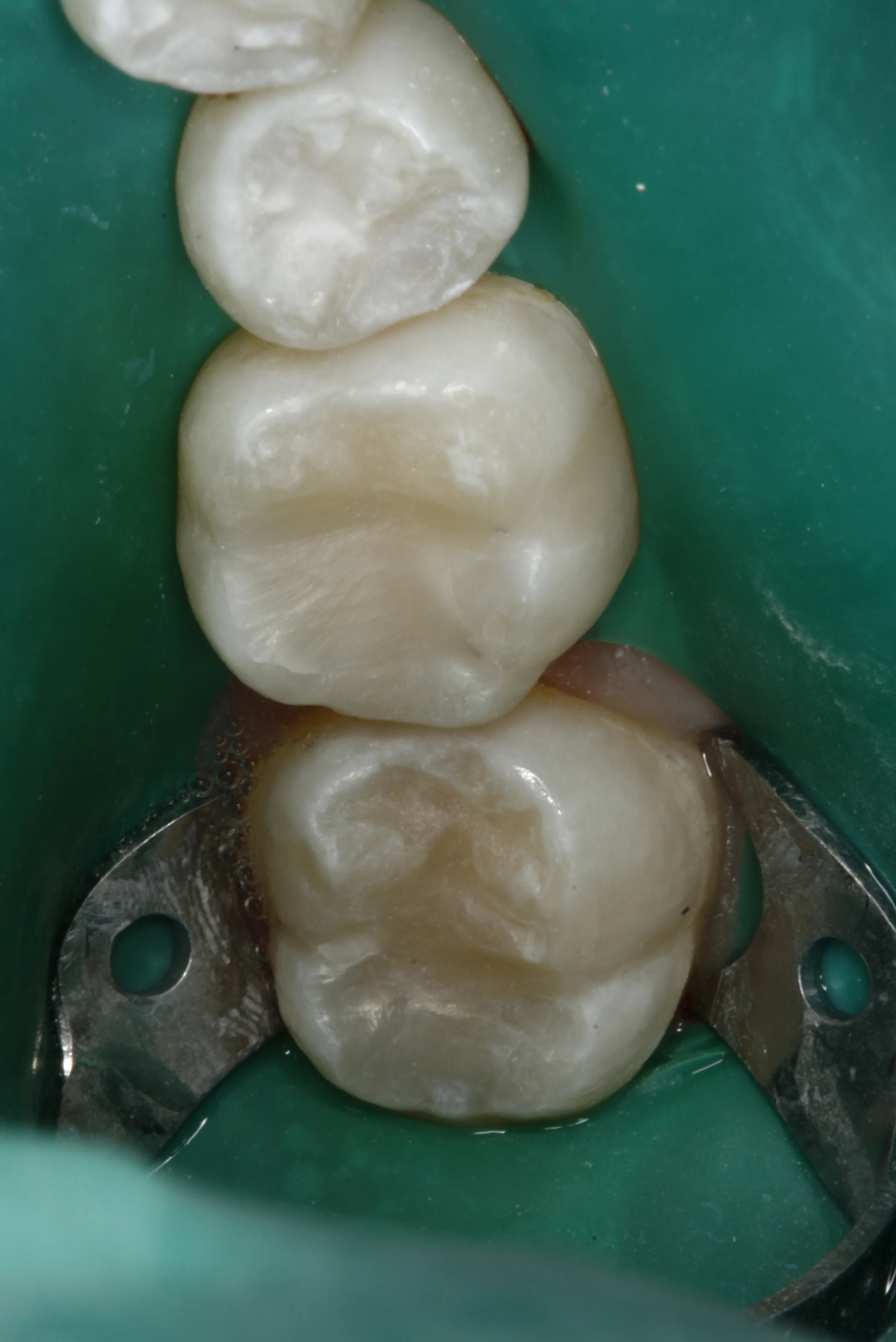 Amber — Lisa L. Buttaro DDS
