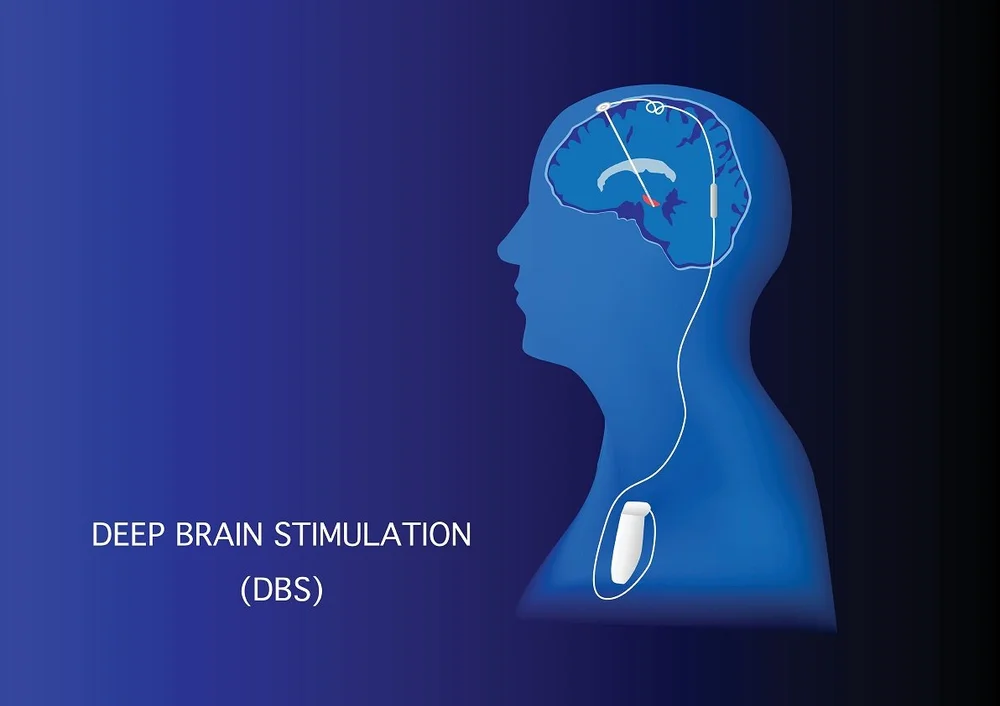 New evidence in support of using deep brain stimulation to treat depression