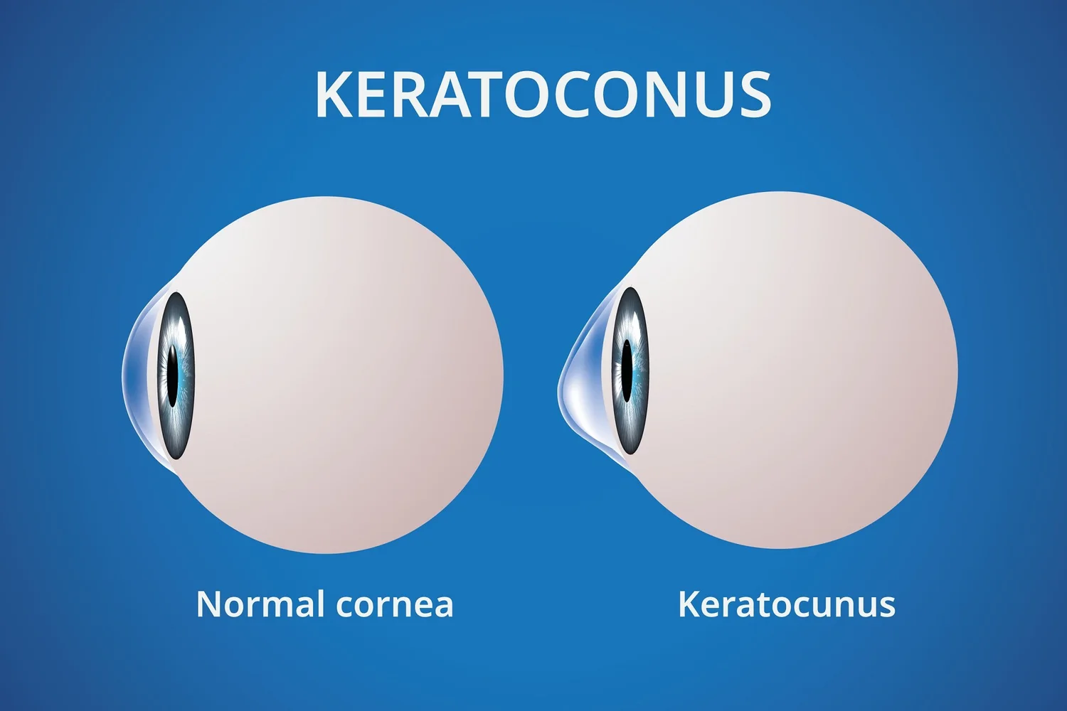 Amazing: bioengineered cornea restores vision for people suffering from ...