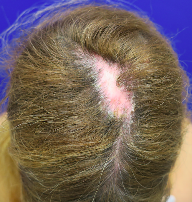 Lichen Planopilaris — Osei-Tutu Dermatology