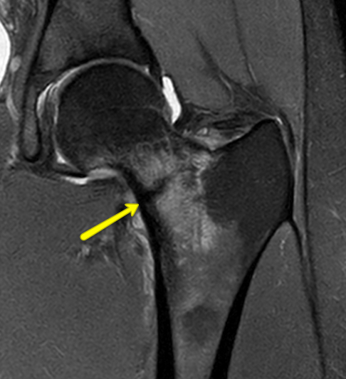 Running with Hip Pain - Femoral Neck Stress Fractures — The Physio Lab
