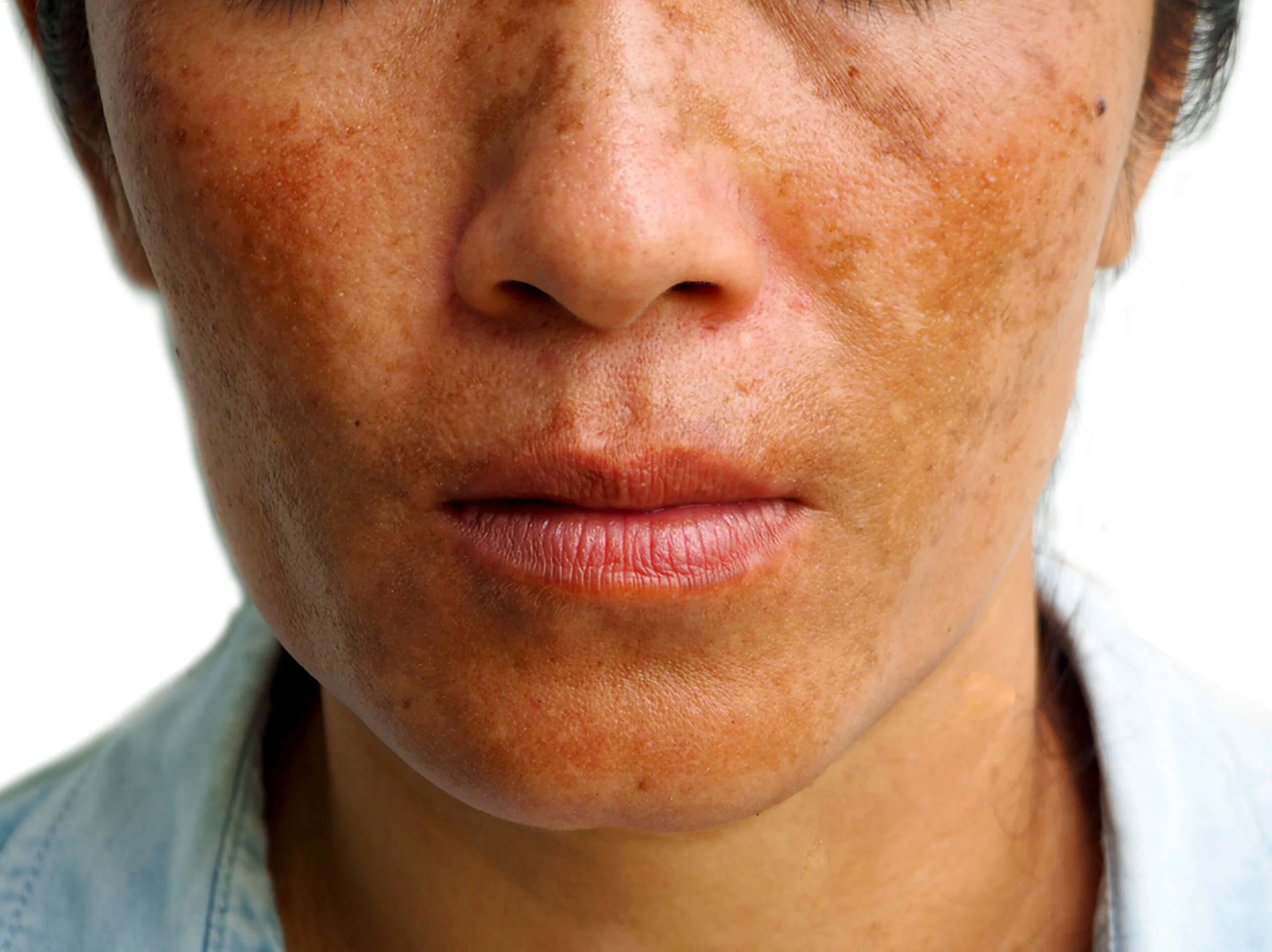 Age Spot Removal and Prevention — Spa 35