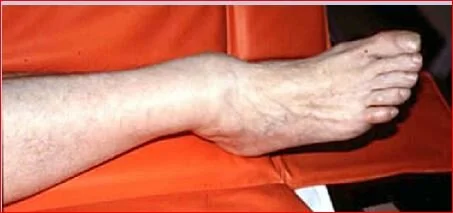 Fractures - General principles, ankle, femur, pelvis — LAMRT Members' Site