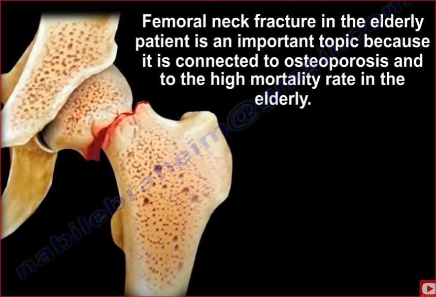 Fractures - General principles, ankle, femur, pelvis — LAMRT Members' Site