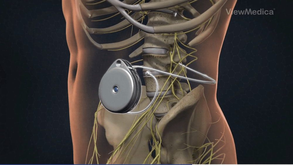 FDA Warns About Unapproved Drugs in Pain Pumps — Pain News Network