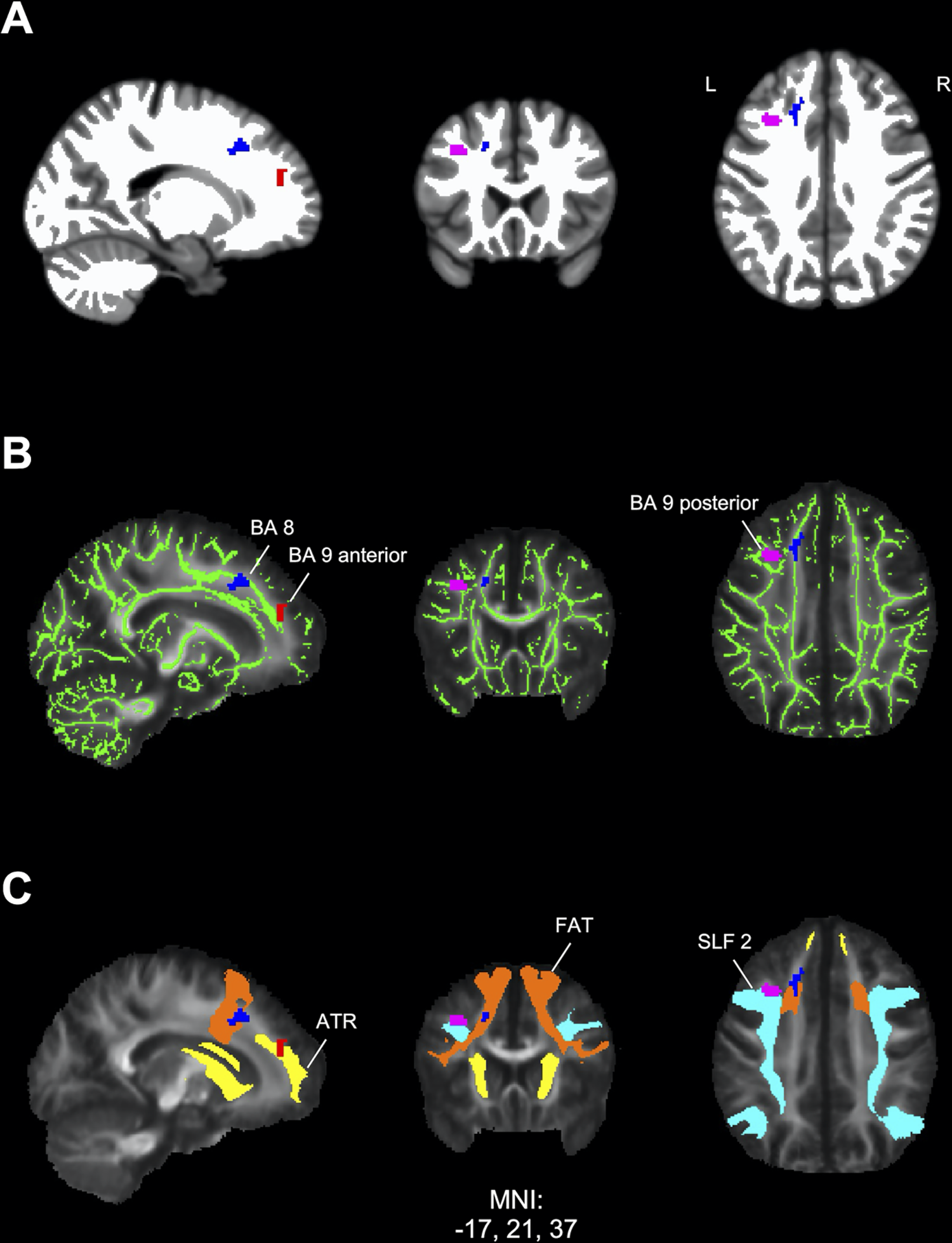 Brain Changes Found in Patients with Long-Term Lyme Disease — Pain News ...