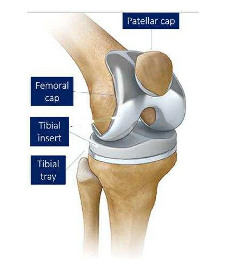 Thousands of Artificial Knees and Hips Wear Out Prematurely — Pain News ...