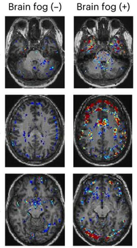 ‘Game Changing’ Study Finds Cause of Long Covid Brain Fog — Pain News ...