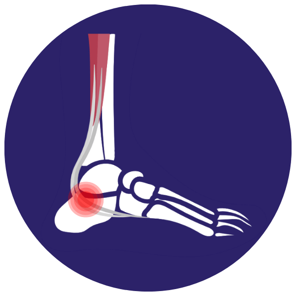 Ankle Sprains In Sport — Richmond Rehab | Physio, Exercise & Massage