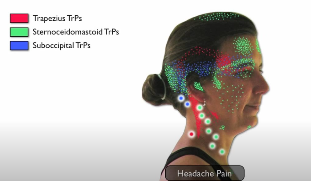 All about headaches — Norwich Osteopathic Clinic