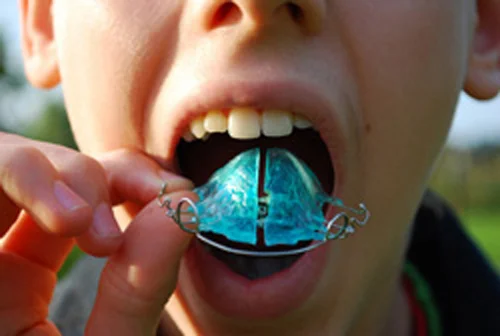 Mint Kids Dentistry - What You Should Know About Retainer for Kids ...