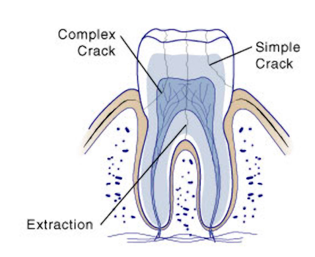 Mint Kids Dentistry - What is Cracked Tooth Syndrome and How to Treat ...