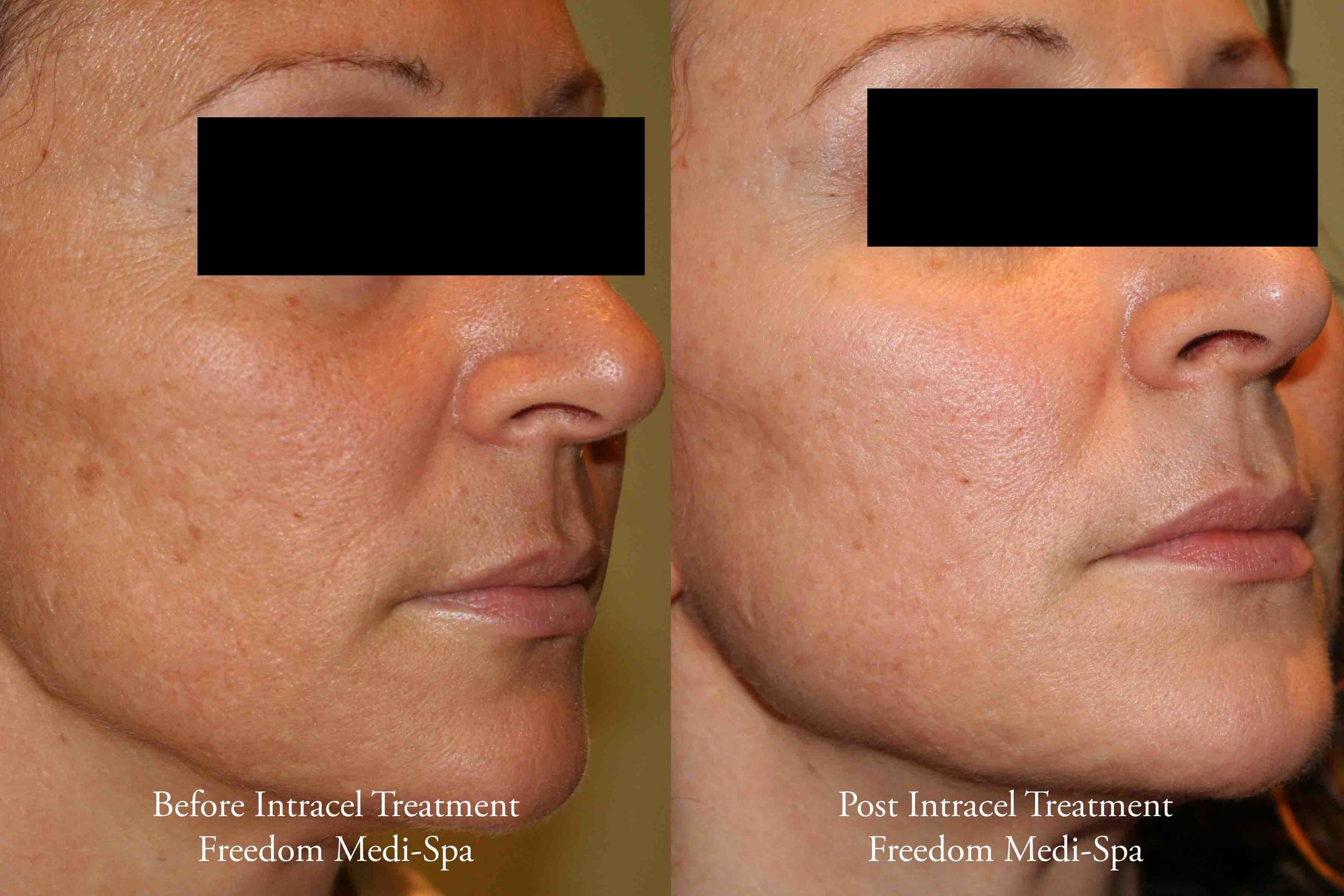 INTRAcel/Skin Tightening — Freedom Medi-Spa
