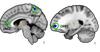 Vagus tVNS — BrainHope.com