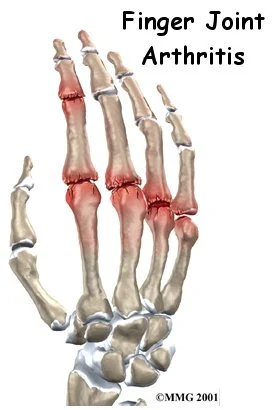 Hand Arthritis Surgery Dallas - Loredo Hand Care Institute