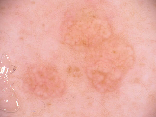 Bumpy Skin, Sebaceous Hyperplasia and Electrocautery by Deborah Tosline ...