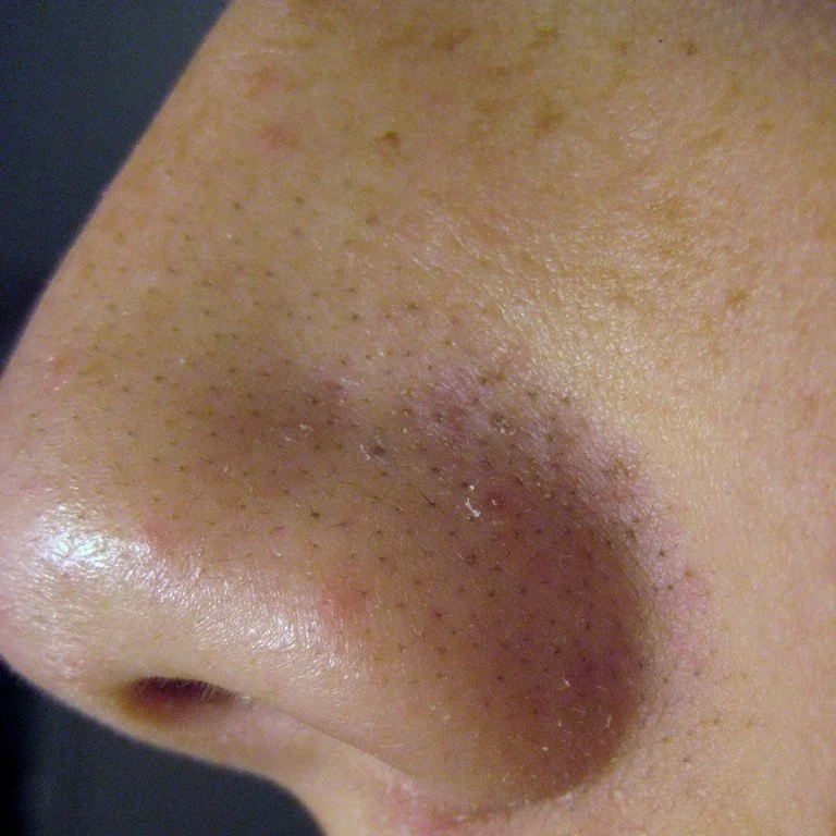 Eliminate Blackheads and Balance the Skin using the Oil Cleansing ...