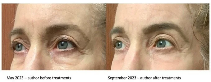 My Coolpeel™ and Vivace™ Med Spa Experiences by Deborah Tosline — Skin ...