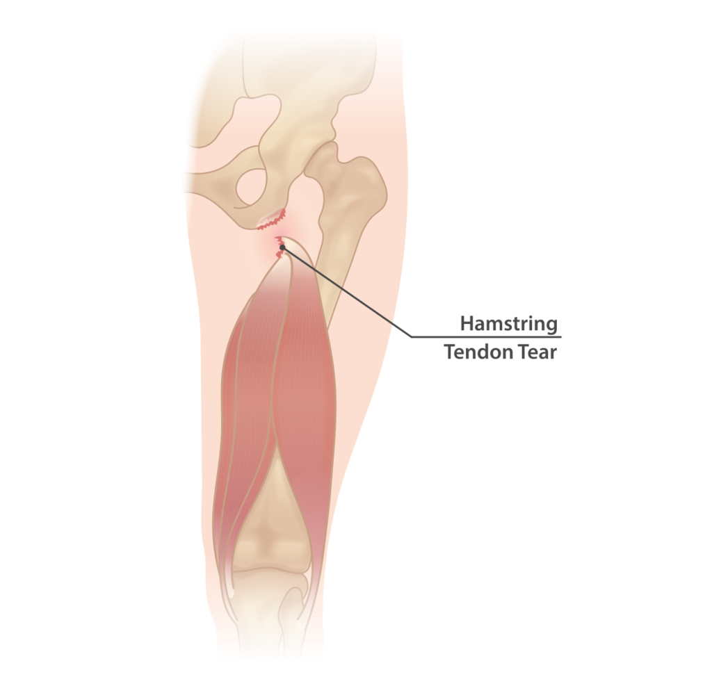 Complete Proximal Hamstring Avulsion and Surgical Reattachment of Hamstring Tendons to Bone by ...