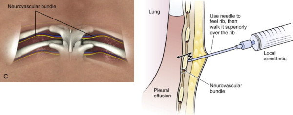 Thoracentesis Procedure Steps
