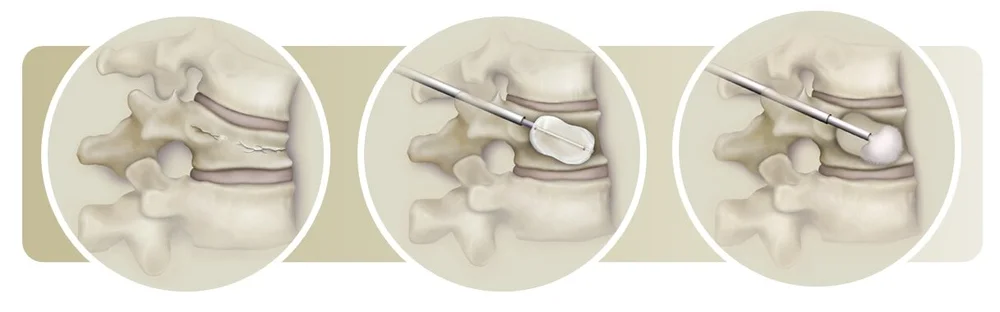 Balloon Kyphoplasty for Vertebral Compression Fracture in Connecticut ...