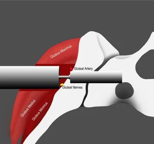 TransLoc 3D™ SI Joint Fusion System — Advanced Diagnostic Pain ...
