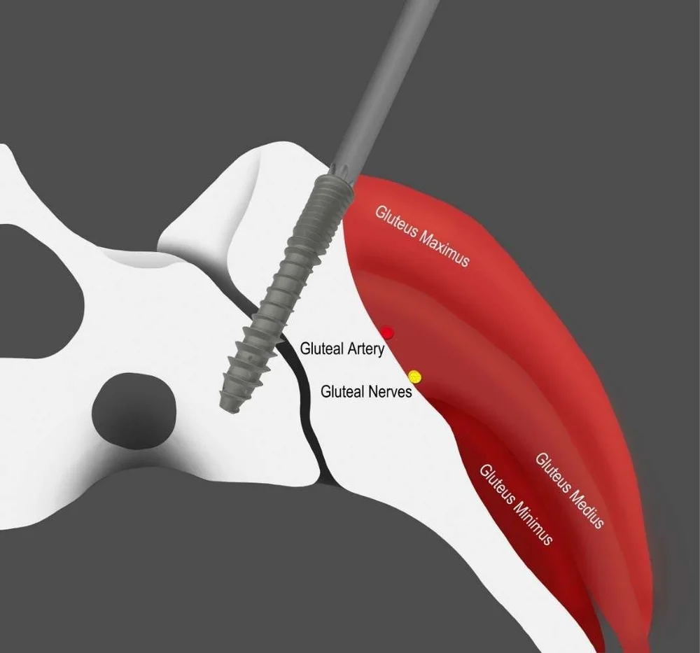TransLoc 3D™ SI Joint Fusion System — Advanced Diagnostic Pain ...