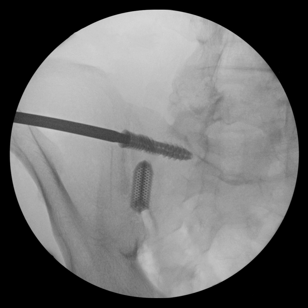 TransLoc 3D™ SI Joint Fusion System — Advanced Diagnostic Pain ...