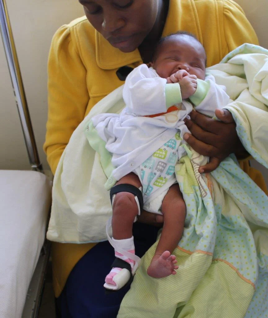 Clubfoot Bracing — Cunningham Prosthetic Care, 47% OFF