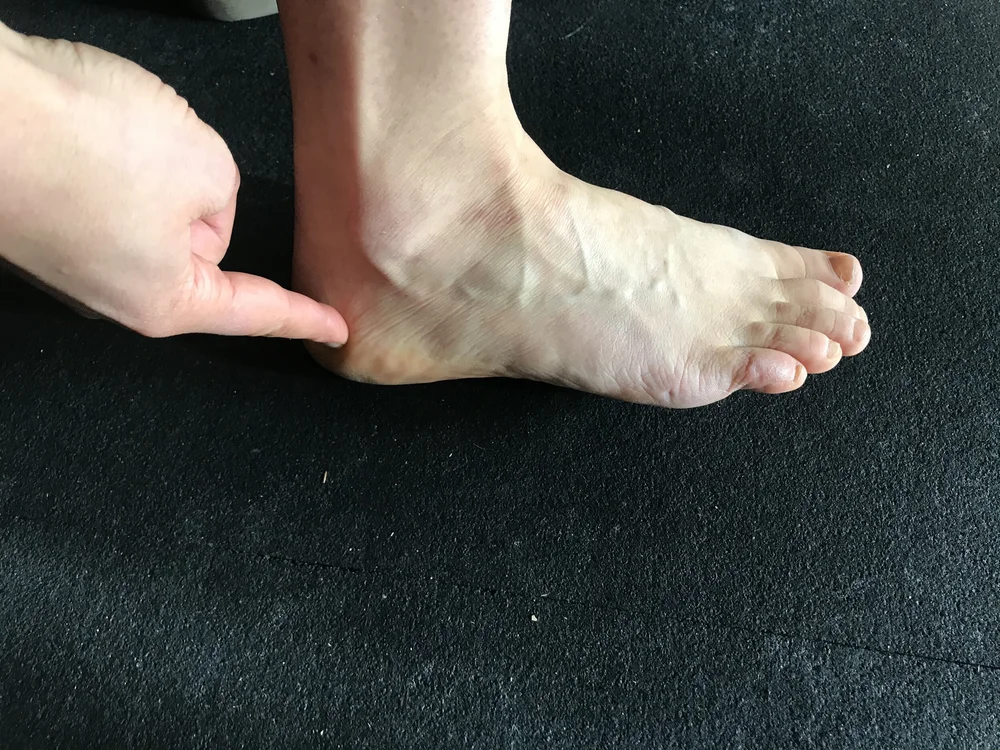 Bone Stress Injuries in Runners: Part 1 — Endurance Physio Missoula ...