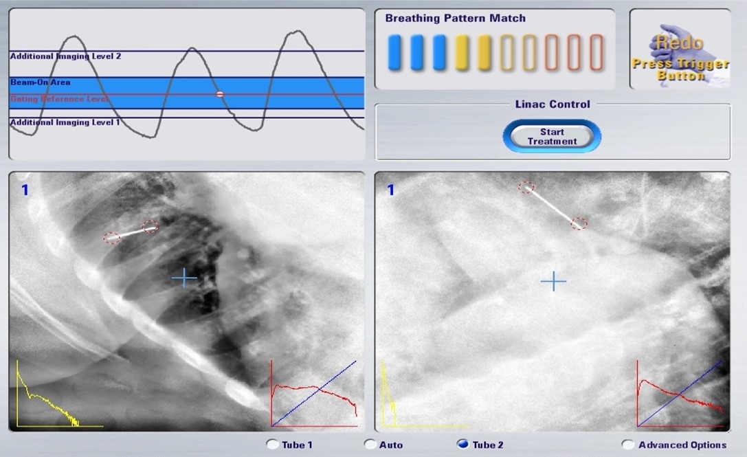 SBRT y Gating — Radioterapia HM