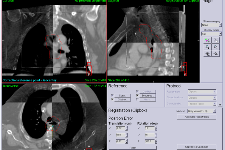 IGRT — Radioterapia HM