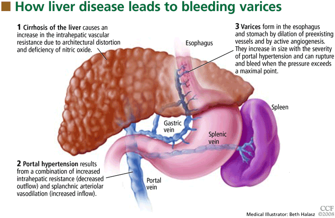 Complications of Cirrhosis: Part 2 — tl;dr pharmacy