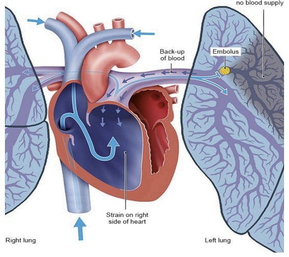 The Pharmacist's Guide to Pulmonary Embolisms (PE) — tl;dr pharmacy