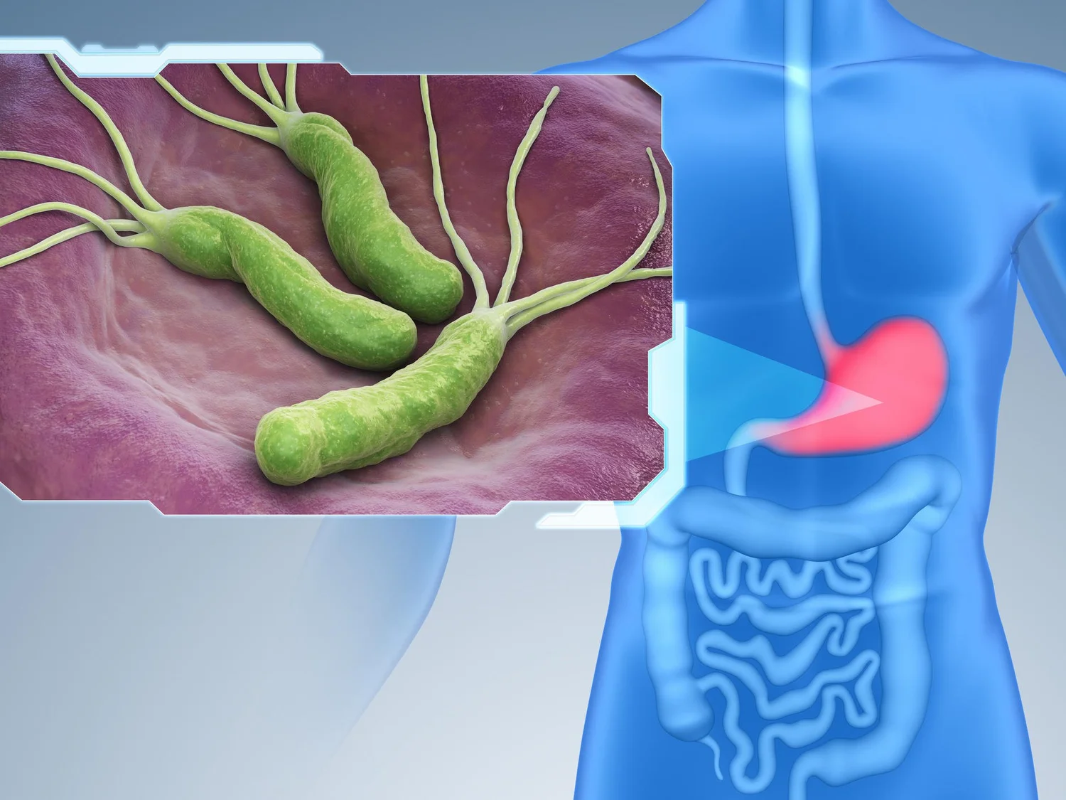 Acute Stabilization of Severe Bleeds Part 3: Gastrointestinal Bleeds ...