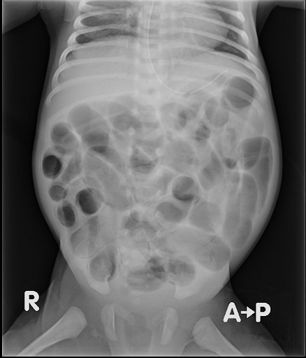 NICU Series Part 3: Necrotizing Enterocolitis (NEC) in Premature ...