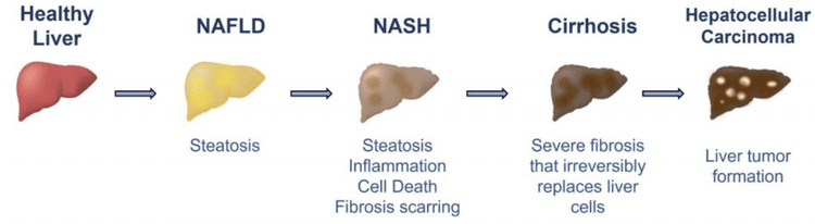 What Every Pharmacist Needs to Know about Non-Alcoholic Fatty Liver ...