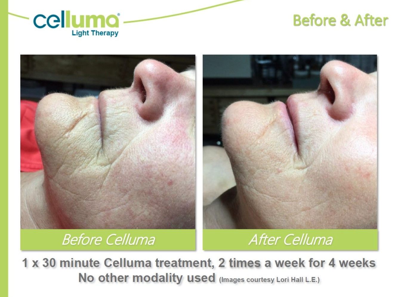 Celluma Light Therapy | Root & Stem — root & stem