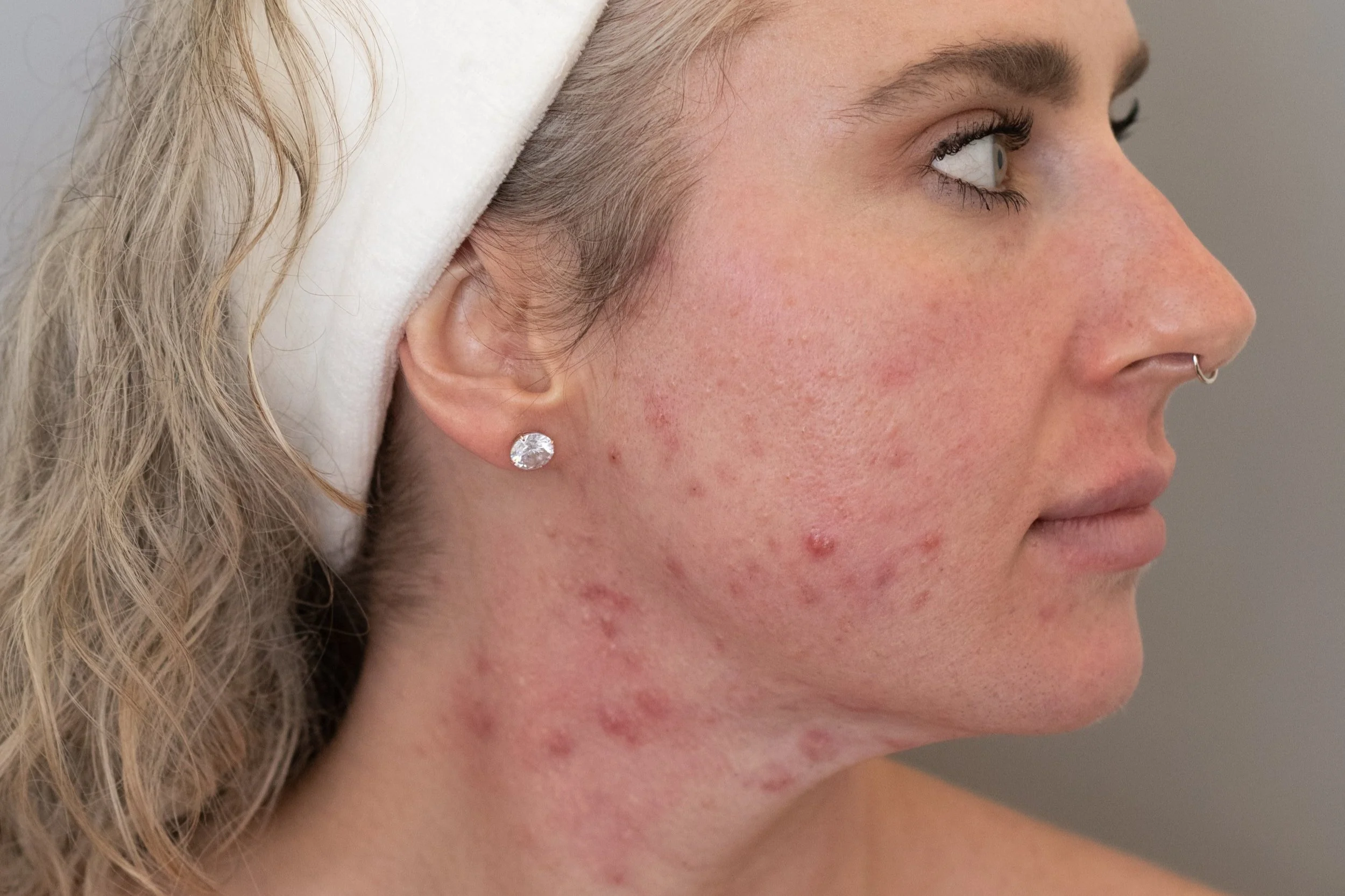 Why Do I Have Acne? — Sacred Skincare