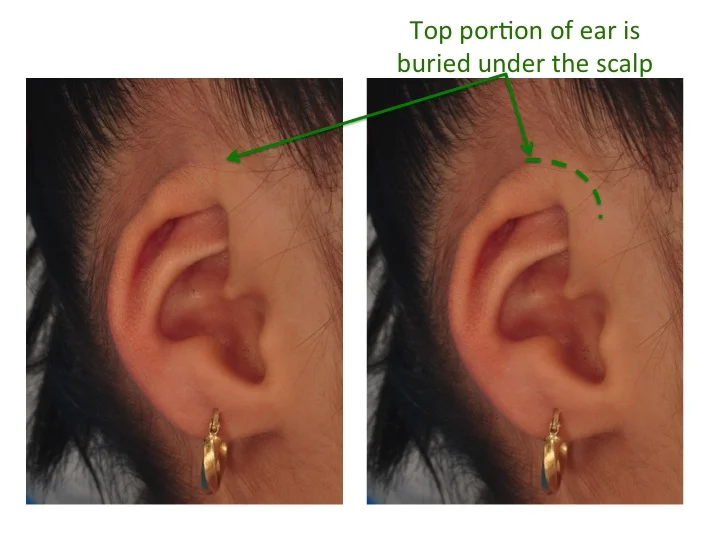Cryptotia — Dallas Pediatric Plastic Surgeon, Craniofacial Surgeon ...