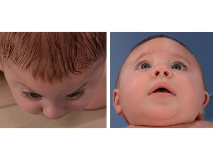 Metopic Synostosis (Trigonocephaly) — Dallas Plastic Surgeon ...