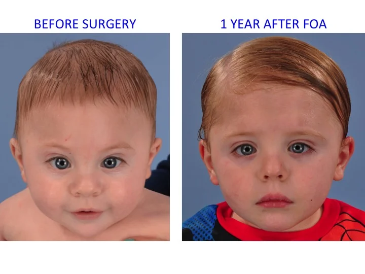 Metopic Synostosis (Trigonocephaly) — Dallas Plastic Surgeon ...