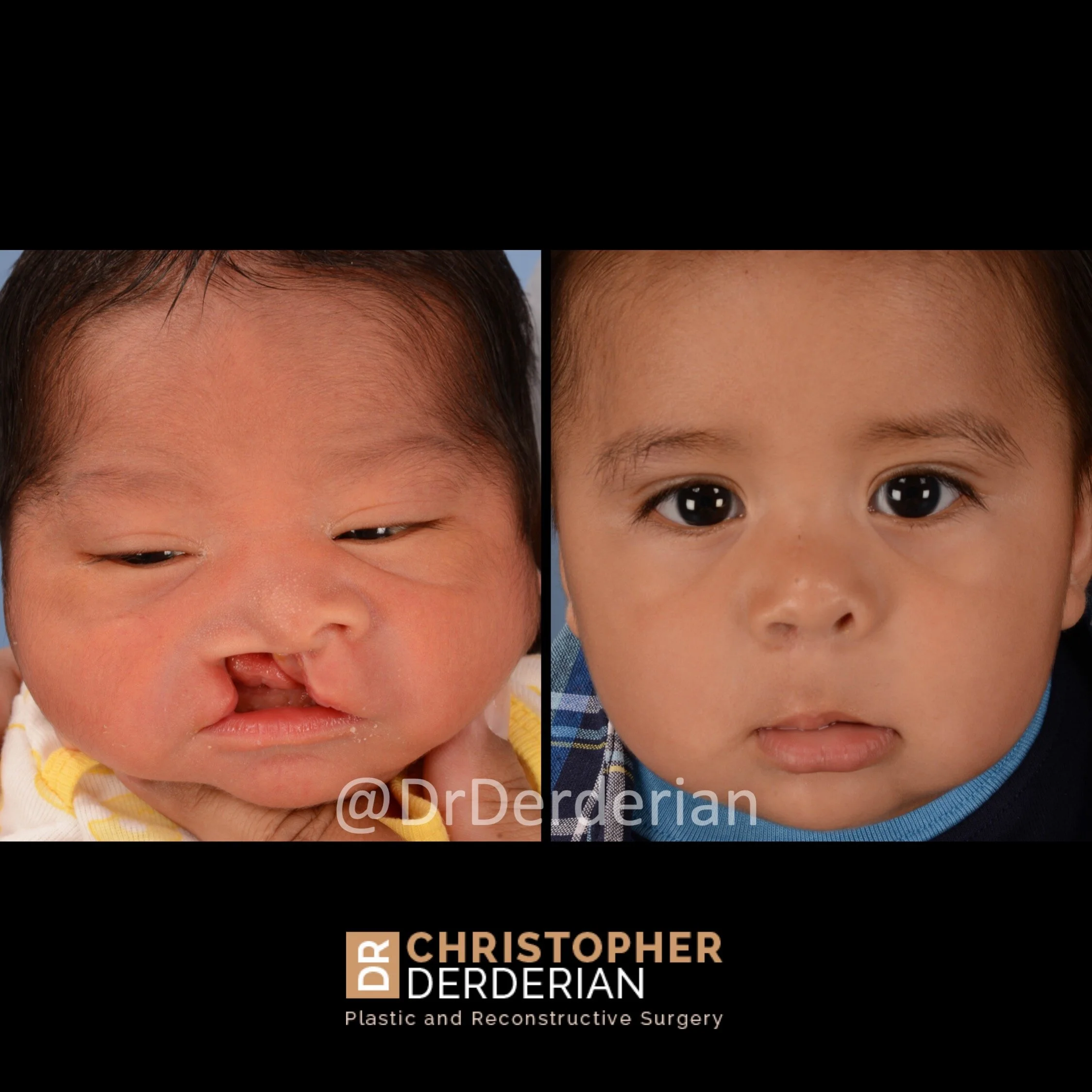 Cleft Rhinoplasty — Dallas Plastic Surgeon specializing in Rhinoplasty ...